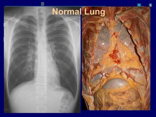 Pathology of Pneumonia | PPS