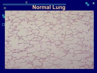 Pneumonia Lung Slide