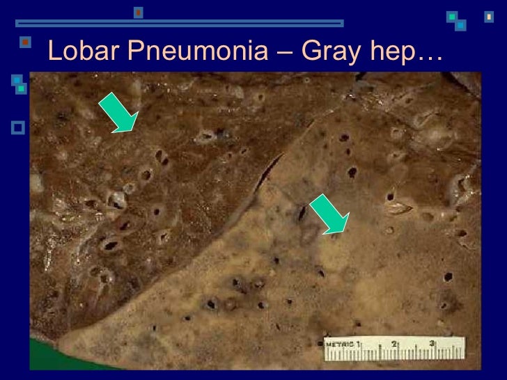 Pathology of Pneumonia