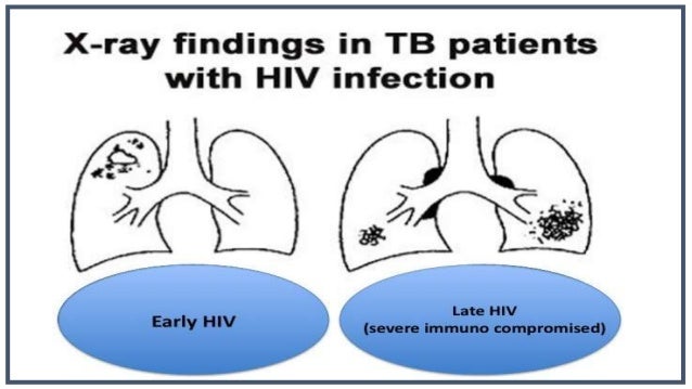 Tb hiv-coinfection