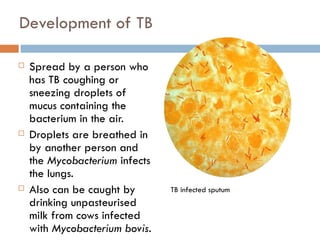 TB a summary | PPT