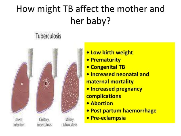 TUBERCULOSIS IN PREGNANCY | PPTX | Pregnancy | Reproductive Health