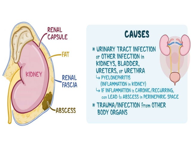 TB And Renal Abscess PPT PDF.pdf