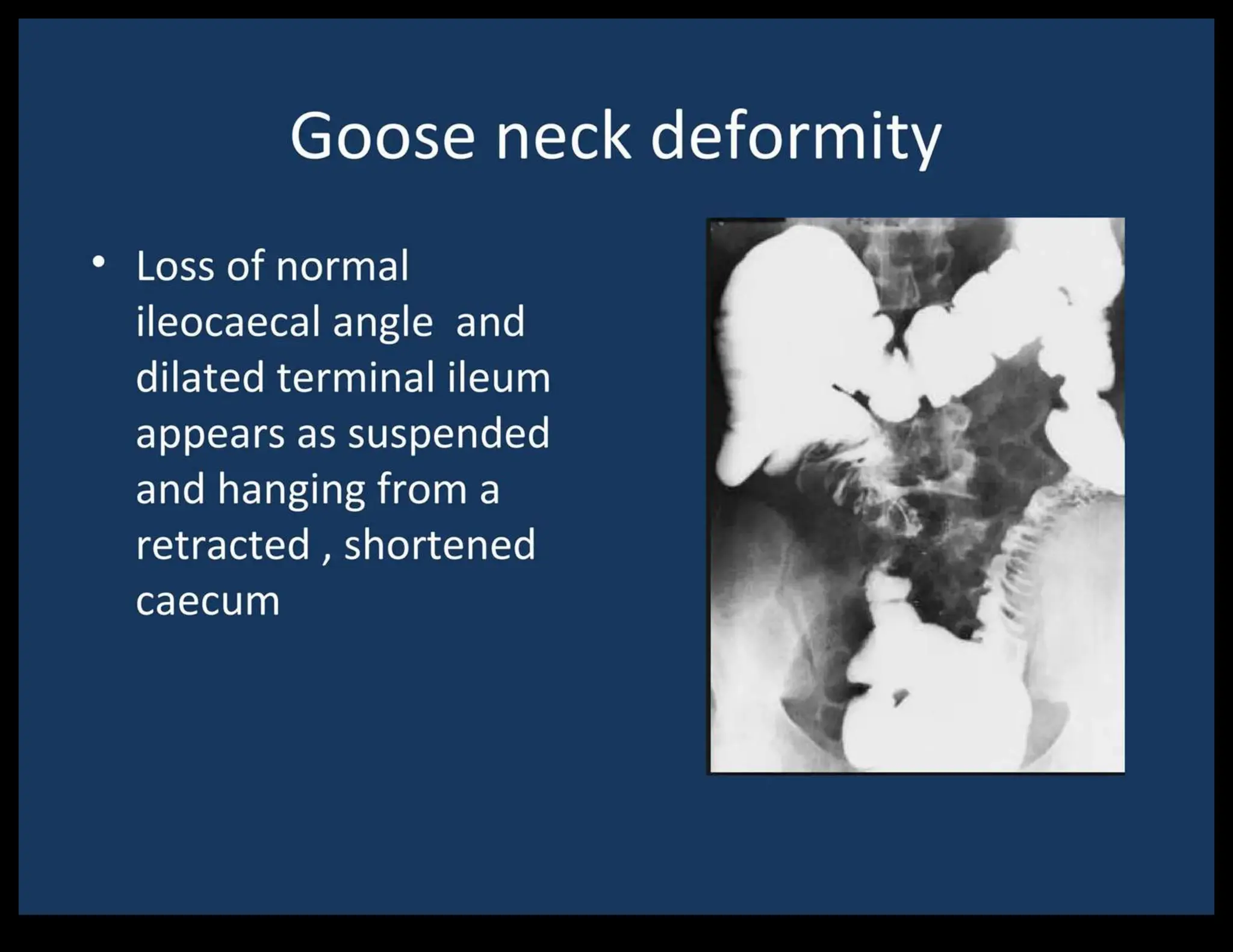 TB and typhoid lesions of small intestine .pptx