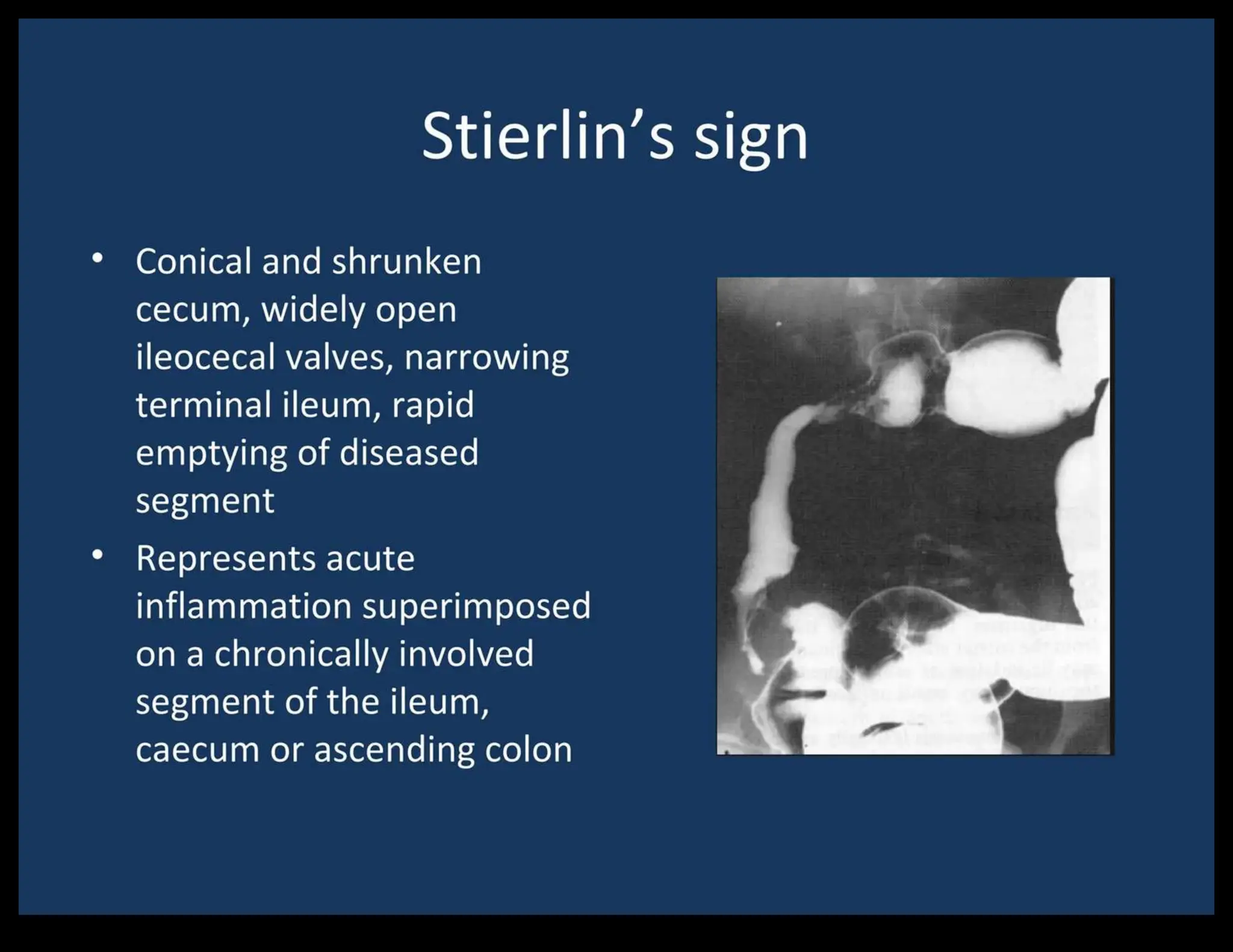 TB and typhoid lesions of small intestine .pptx