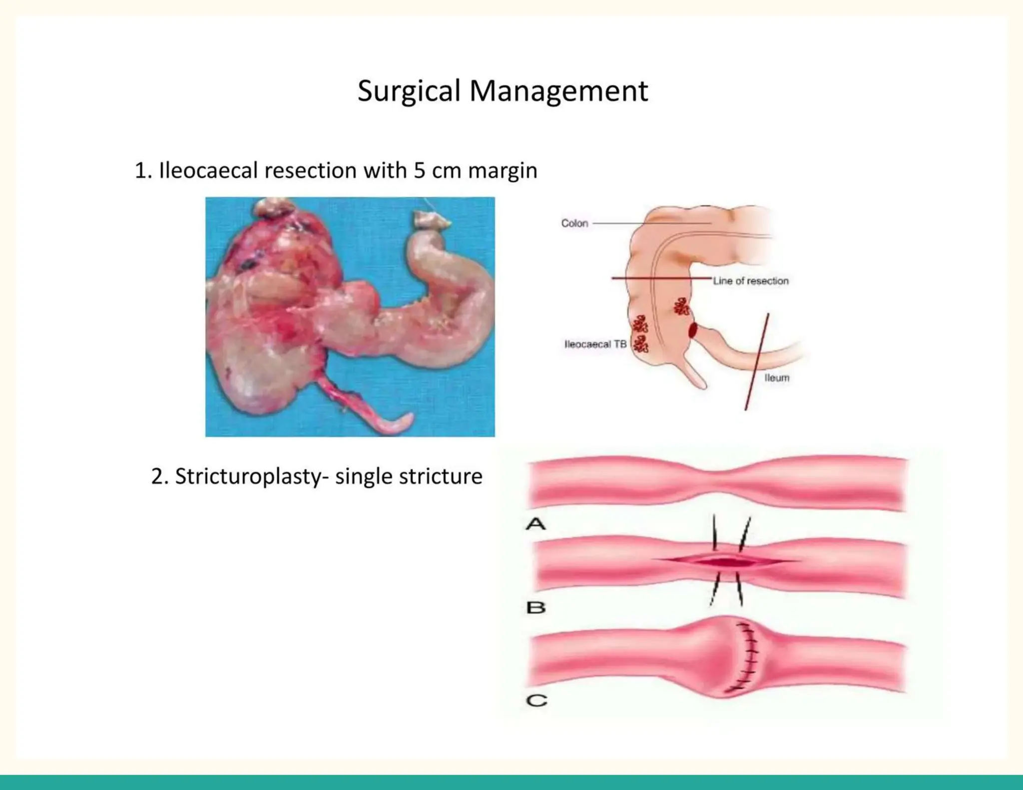 TB and typhoid lesions of small intestine .pptx