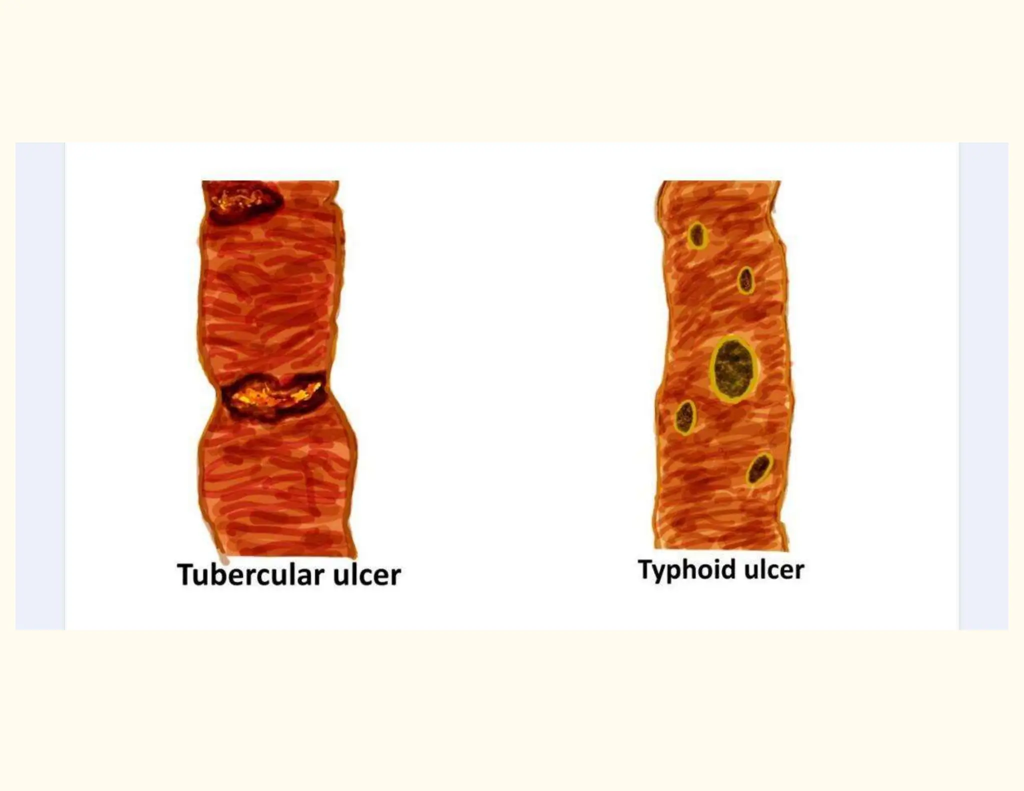 TB and typhoid lesions of small intestine .pptx