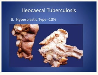 TB and typhoid lesions of small intestine .pptx
