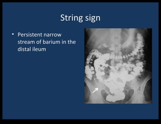 TB and typhoid lesions of small intestine .pptx