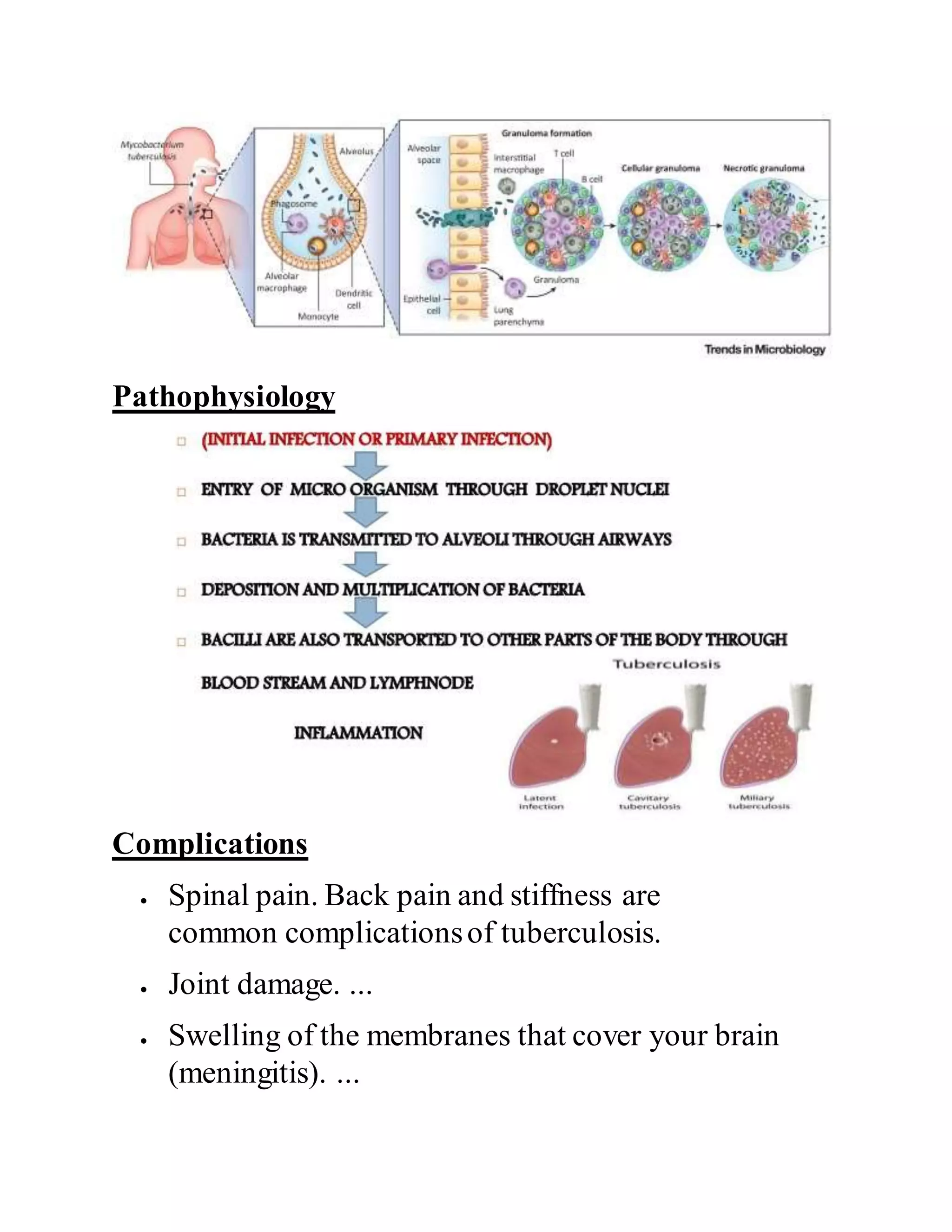 Tuberclosis | DOCX