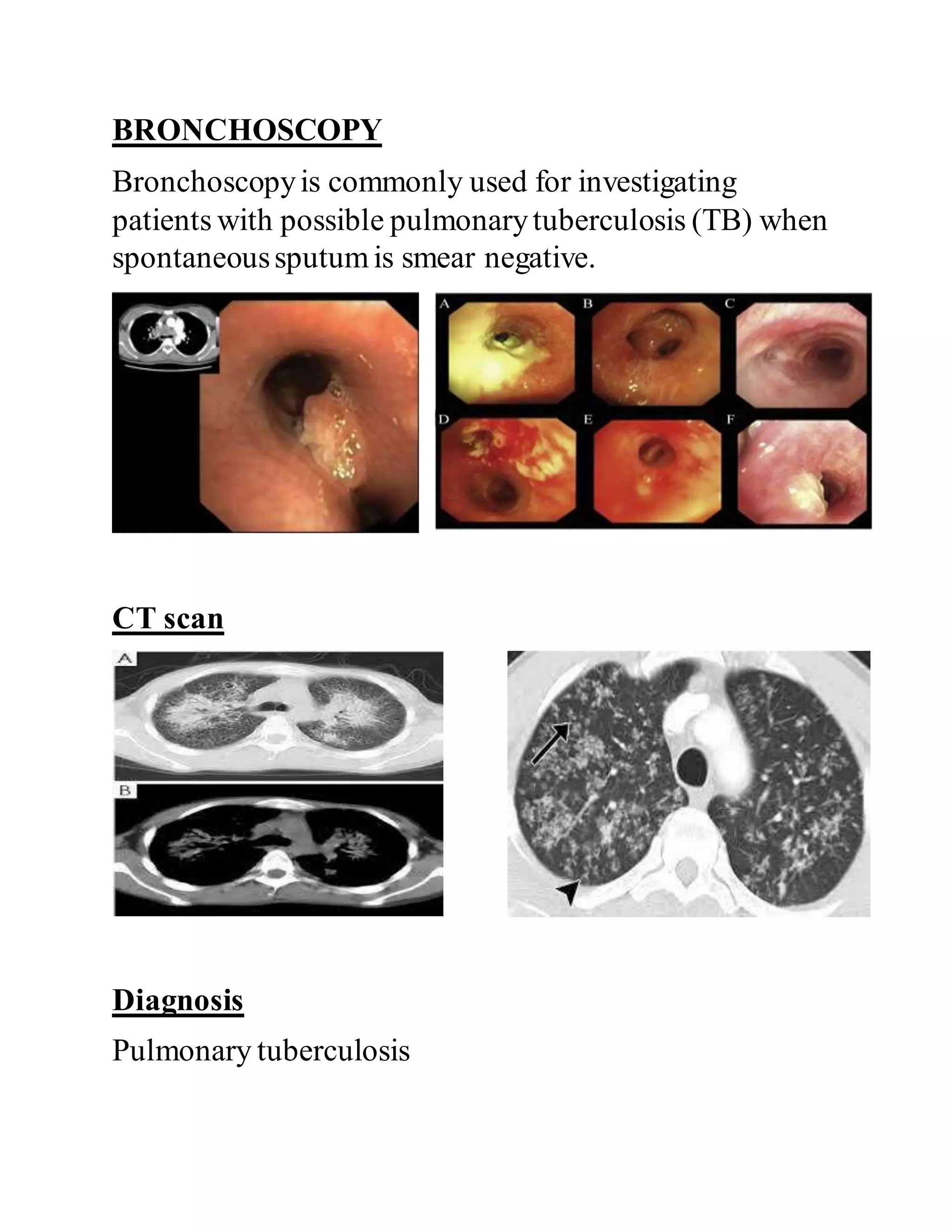 Tuberclosis | DOCX