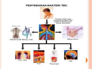 Tbc | PPTX