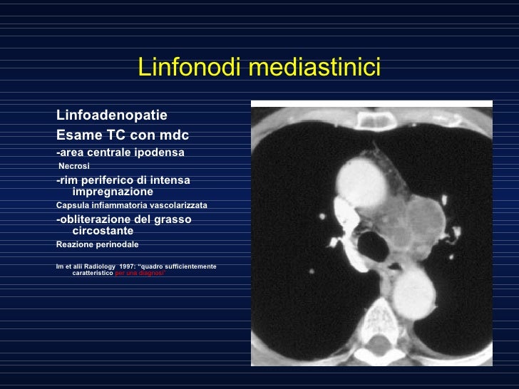 Linfonodi Mediastinici Corpo Umano La Guida Per