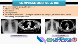 Tbc pulmonar-final | PPTX