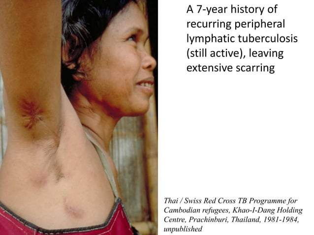 TB CASE STUDY.pptx | Free Download