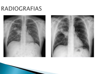 Tuberculosis y Quimioprofilaxis | PPTX