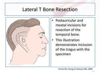 Temporal Bone Carcinoma | PPTX