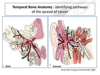 Temporal Bone Carcinoma | PPTX