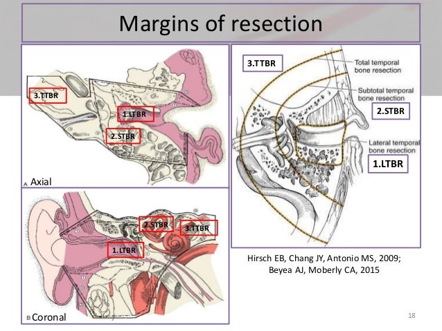 Temporal Bone Carcinoma