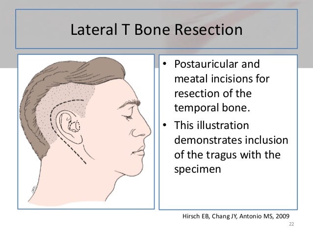 Temporal Bone Carcinoma