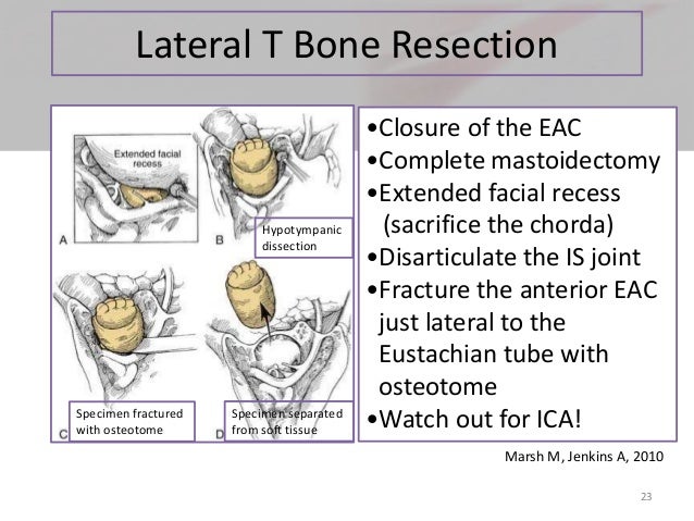 Temporal Bone Carcinoma