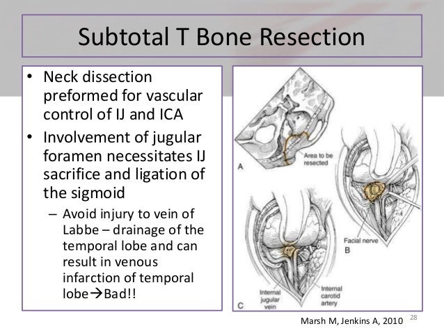 Temporal Bone Carcinoma