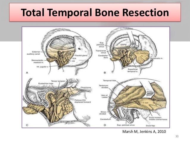 Temporal Bone Carcinoma