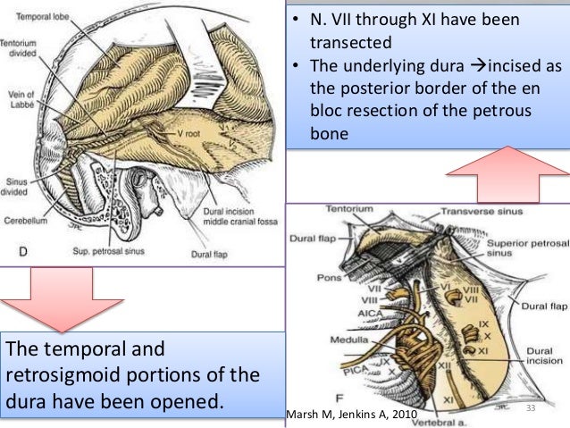 Temporal Bone Carcinoma