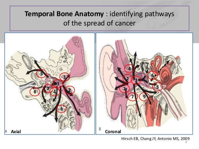 Temporal Bone Carcinoma