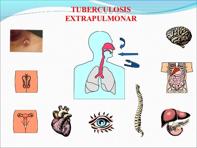 Tbc pulmonar y extrapulmonar