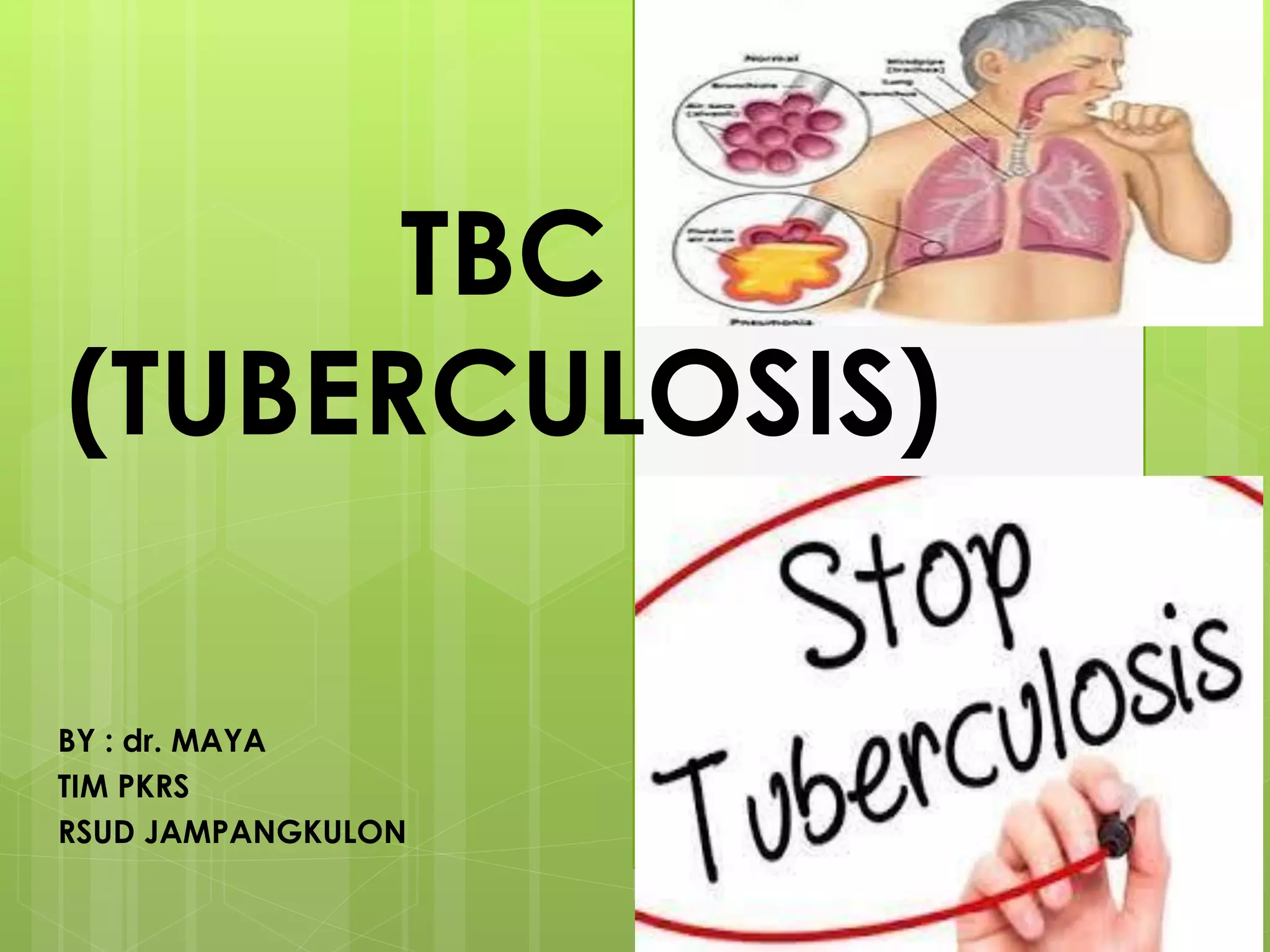 TBC (TUBERCULOSIS) PRESENTASI.pdf