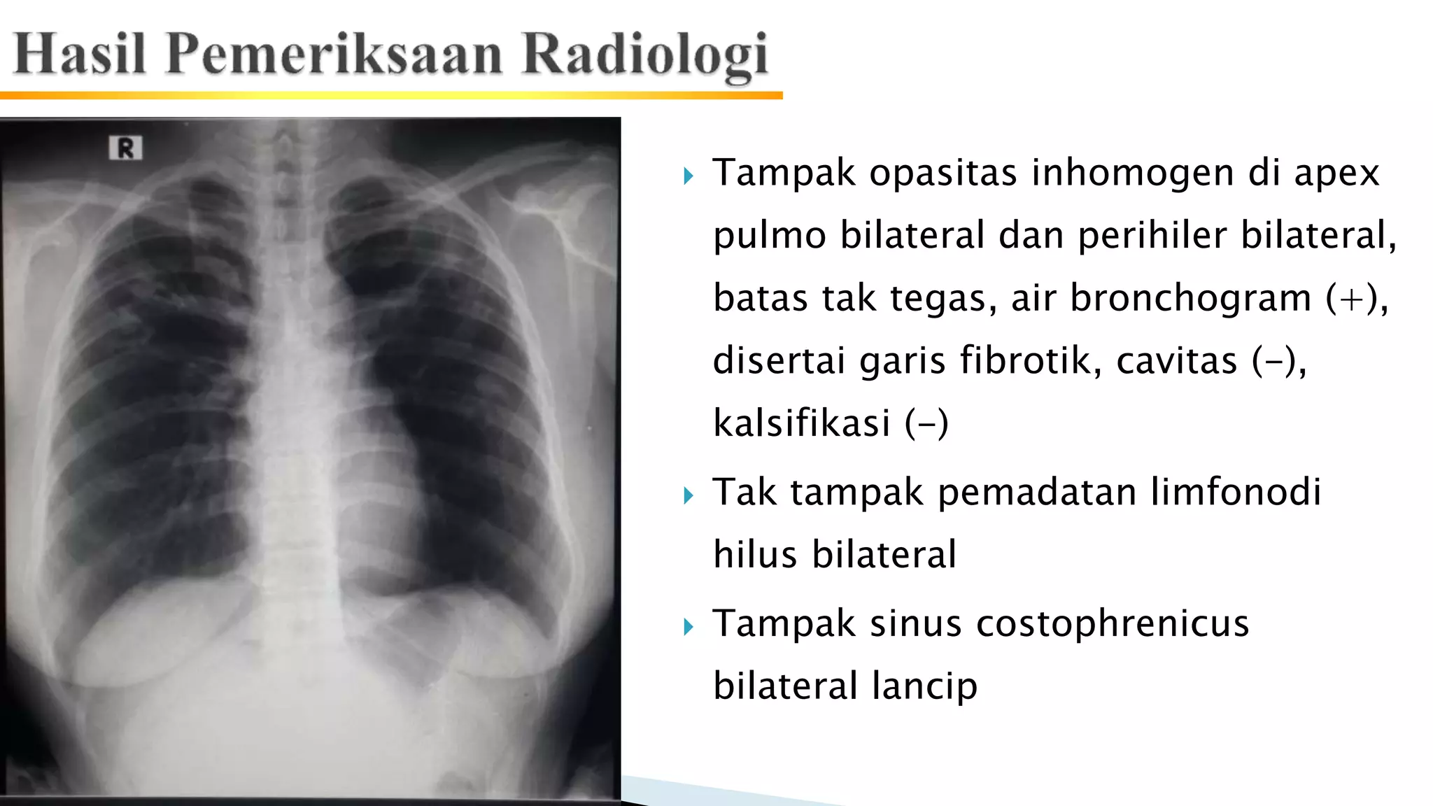 Tb duplex lama aktif | PPTX