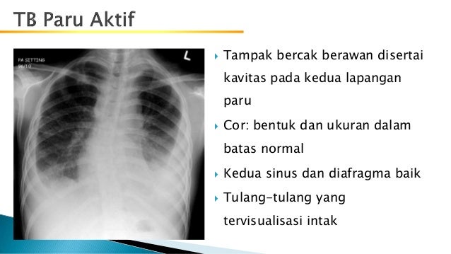 Hasil X Ray Paru Paru Normal Nursing Education Laporan Pendahuluan Askep Dan Ppt Tb Paru