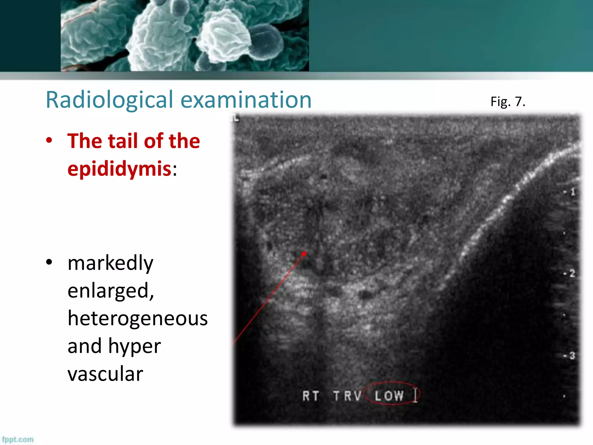 Tb epididymitis, By Emad M.Qasem | PPT