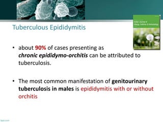 Tb epididymitis, By Emad M.Qasem | PPSX