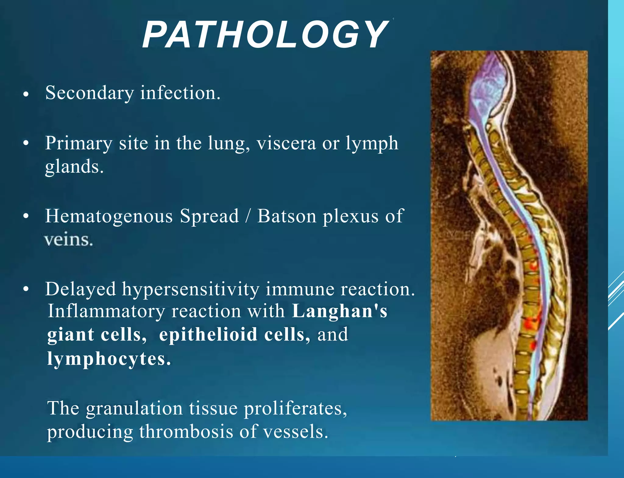 TB & fungal infection of the spine adnan al bannna | PPTX | Bone and ...
