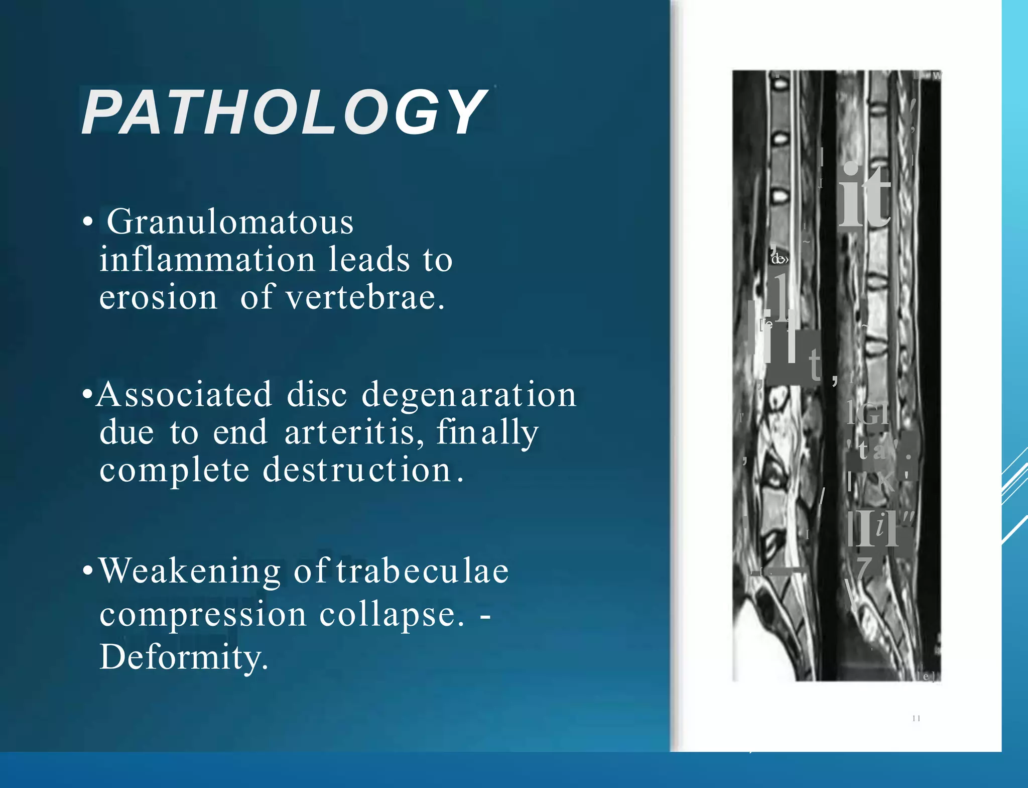 TB & fungal infection of the spine adnan al bannna | PPTX | Bone and ...