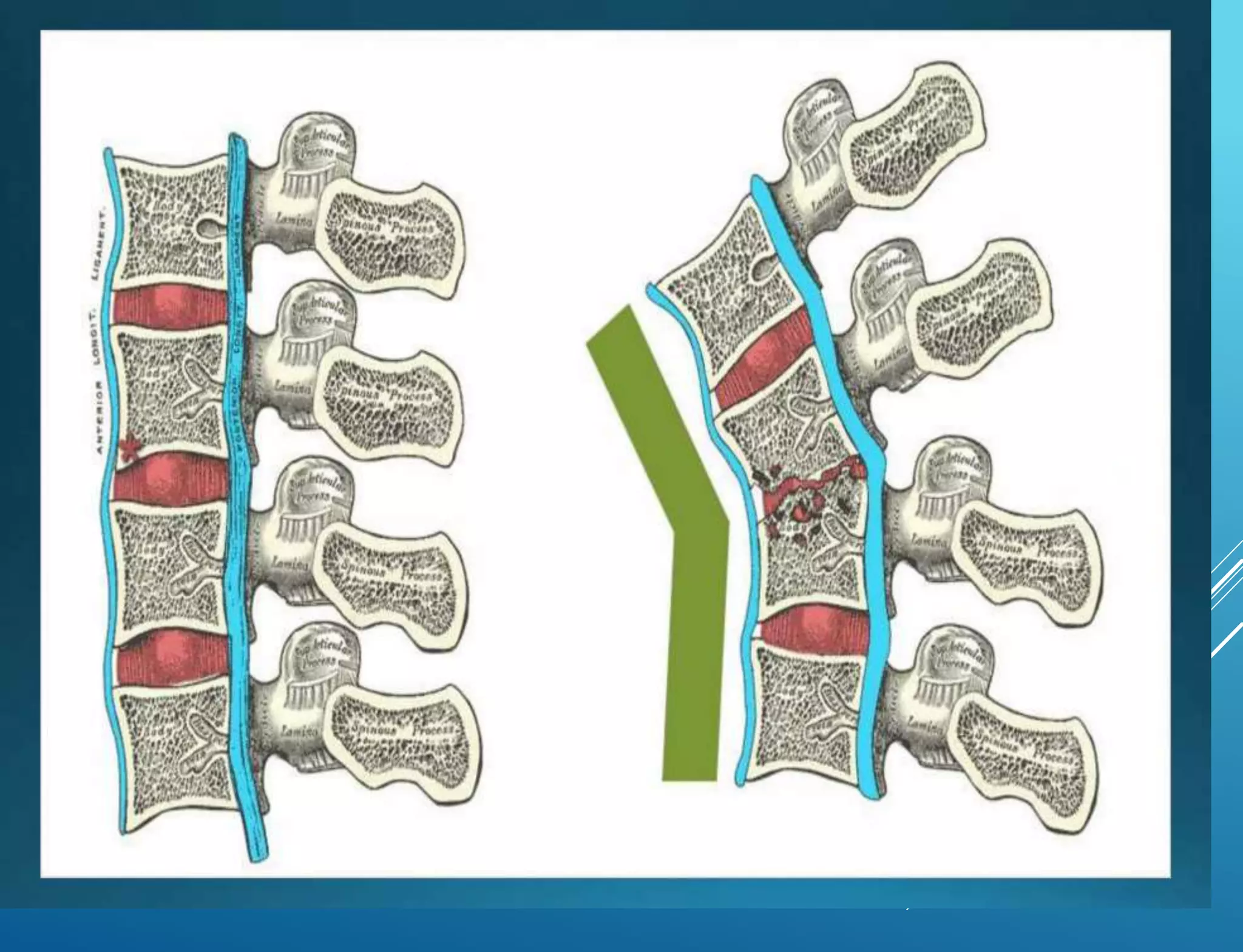 TB & fungal infection of the spine adnan al bannna | PPTX | Bone and ...