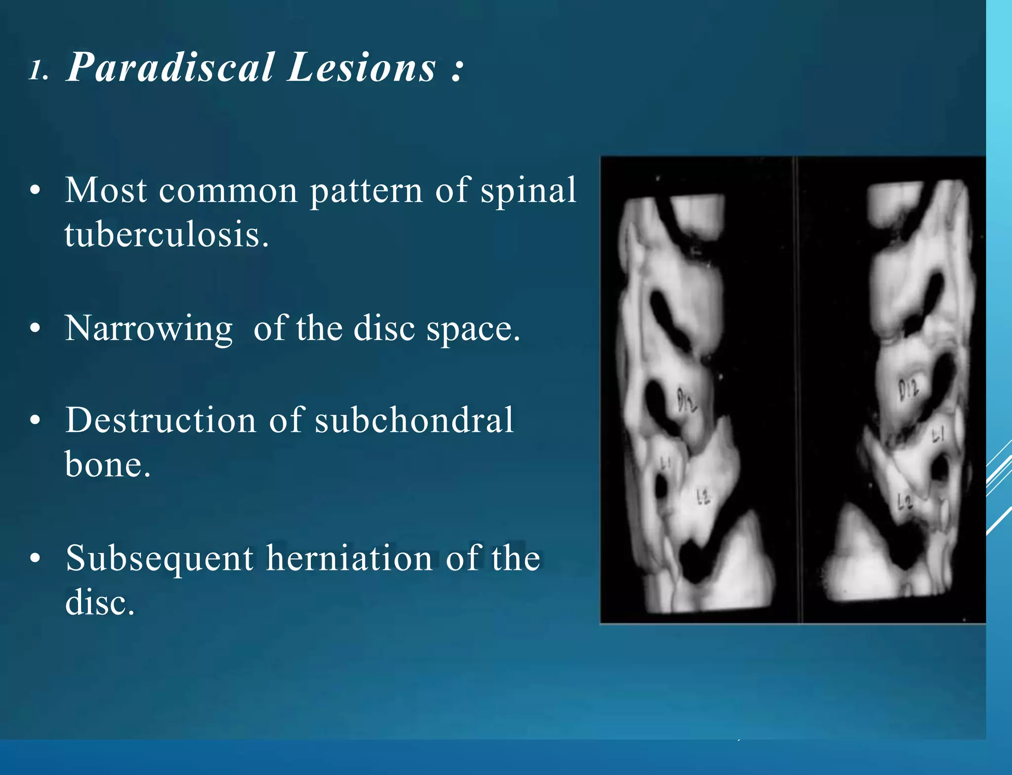TB & fungal infection of the spine adnan al bannna | PPTX | Bone and ...