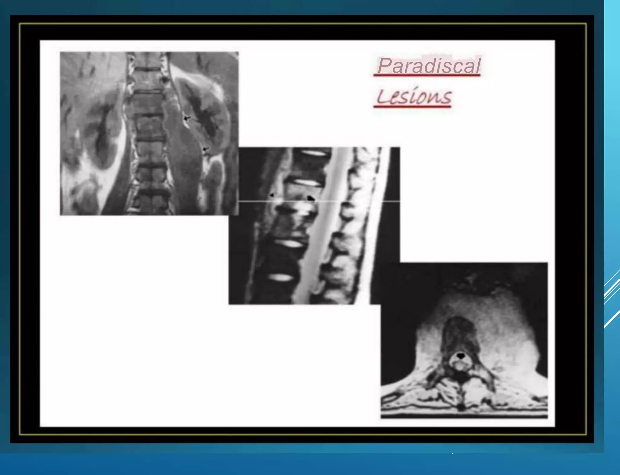 TB & fungal infection of the spine adnan al bannna | PPTX | Bone and ...
