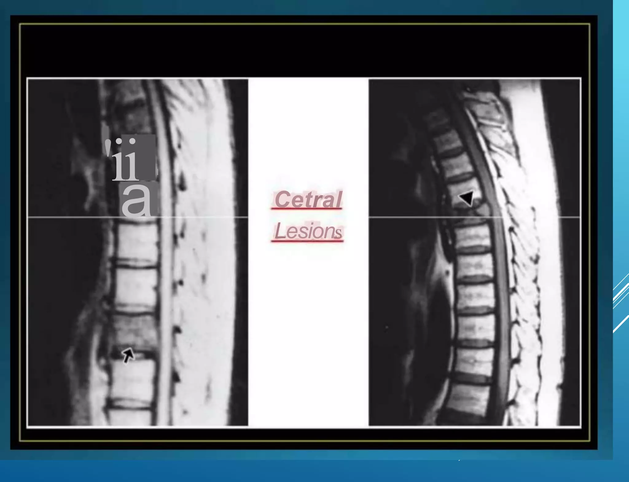 TB & fungal infection of the spine adnan al bannna | PPTX | Bone and ...
