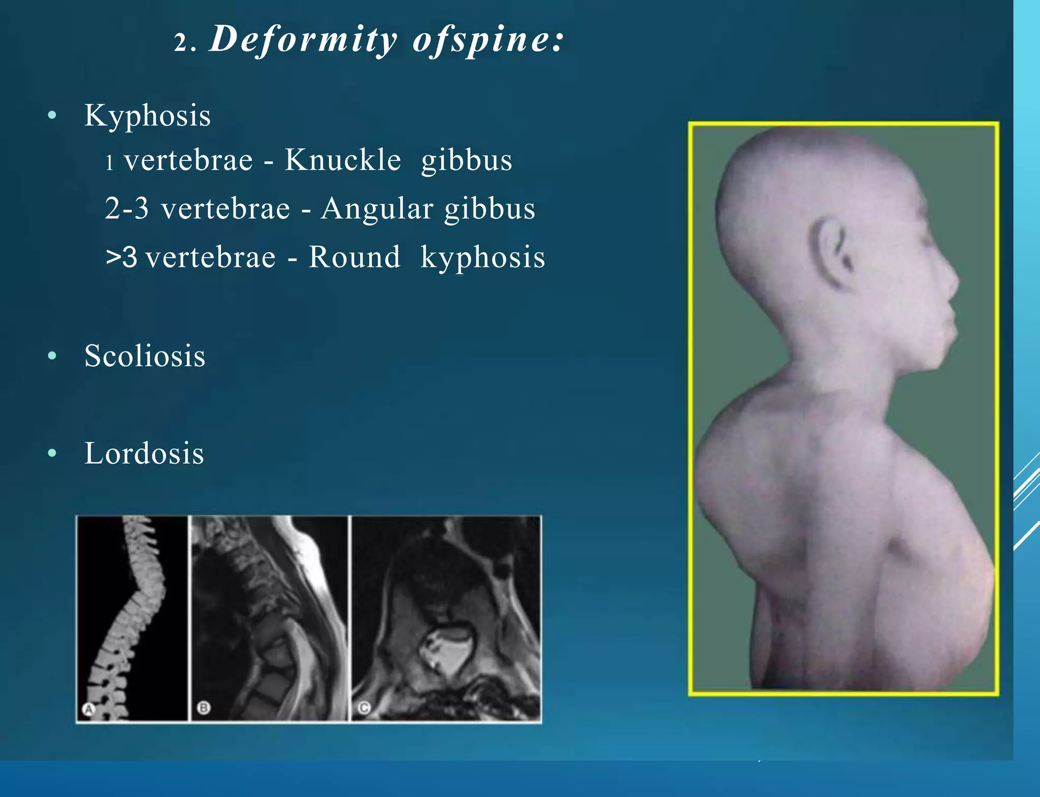 TB & fungal infection of the spine adnan al bannna | PPTX | Bone and ...