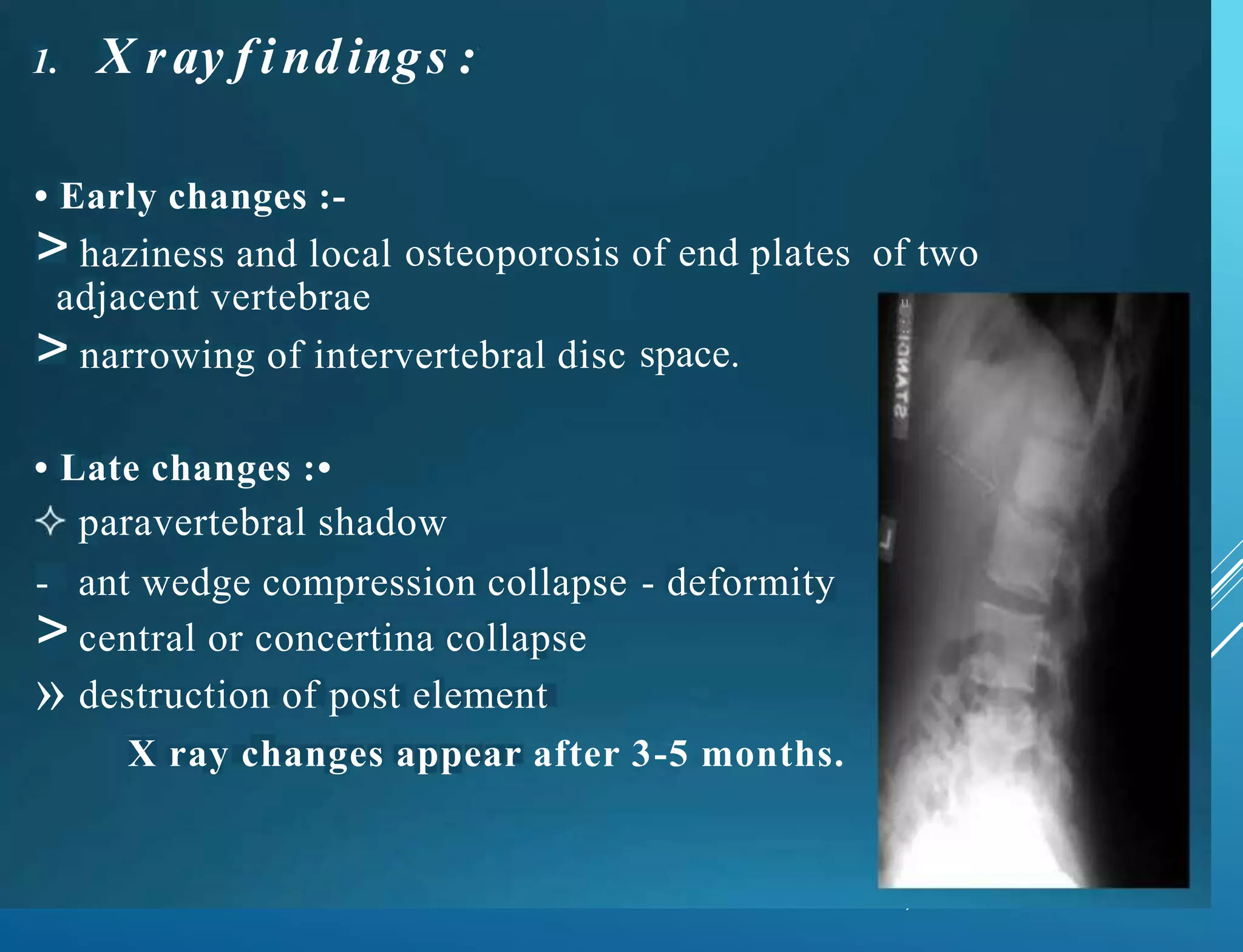 TB & fungal infection of the spine adnan al bannna | PPTX | Bone and ...