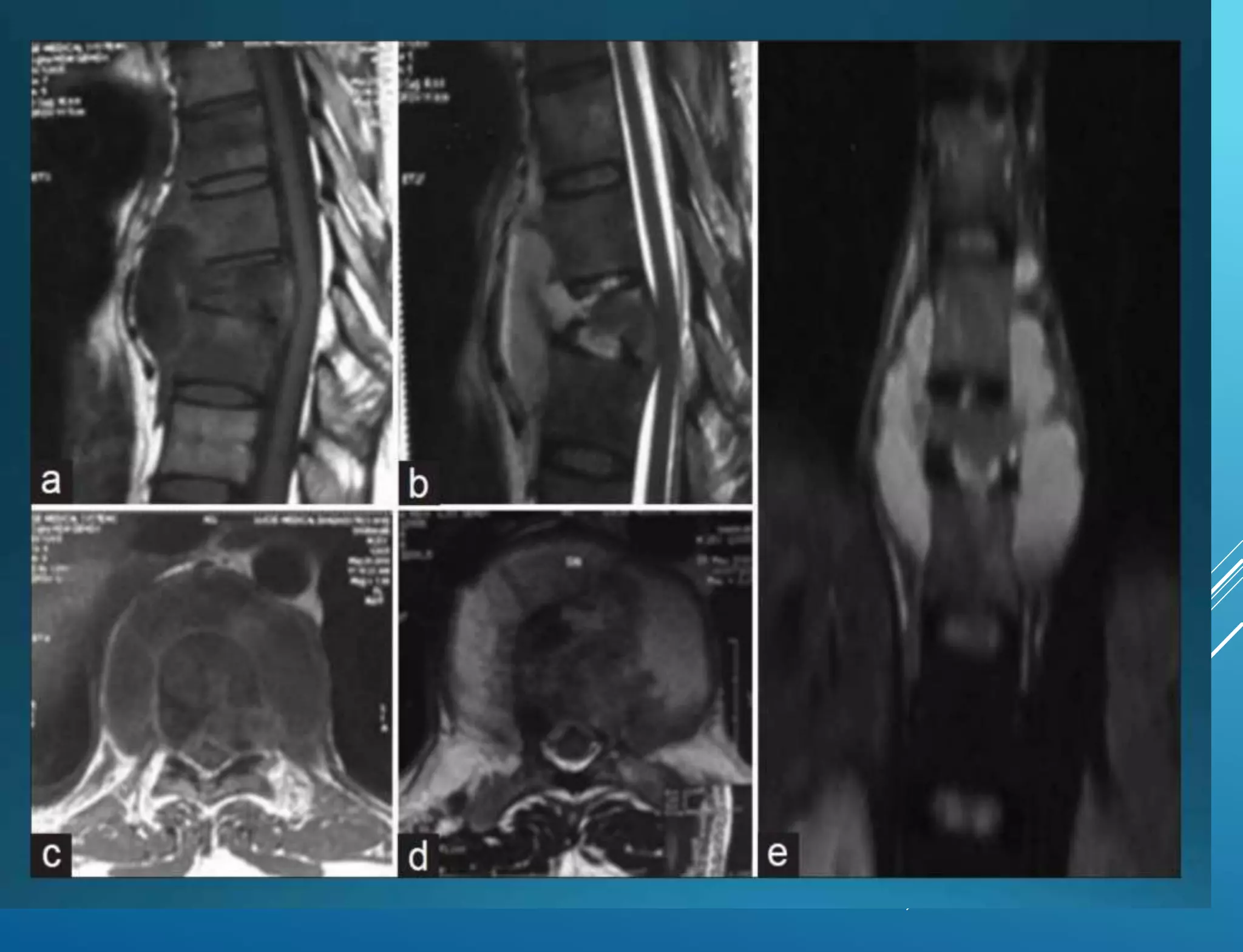 TB & fungal infection of the spine adnan al bannna | PPTX | Bone and ...