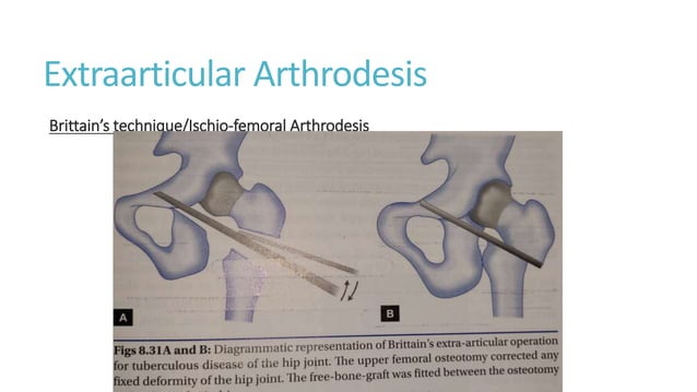 Tuberculosis of Hip | PPT