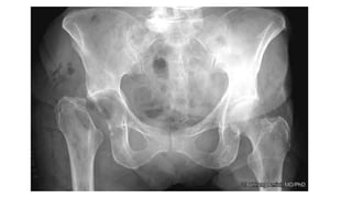 TUBERCULOSIS OF HIP JOINT | PPTX