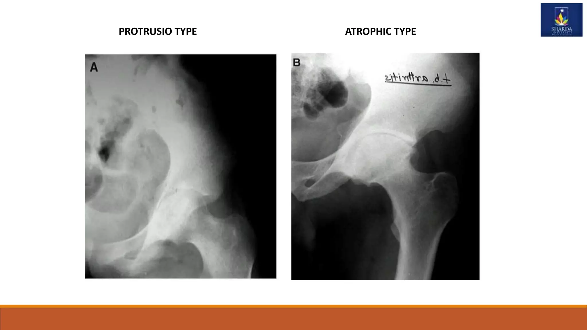 Tuberculosis of HIP Joint | PPTX