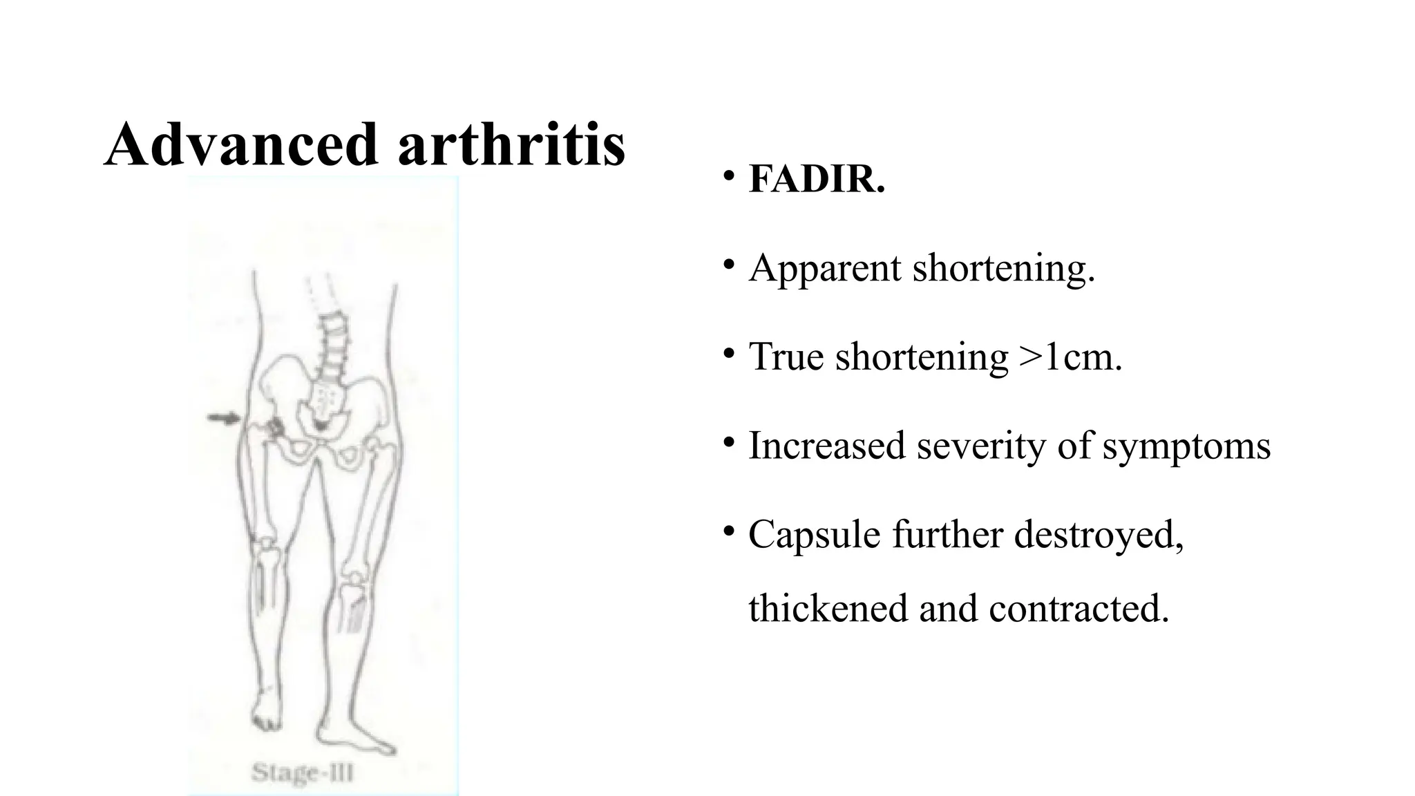 Tuberculosis of Hip joint FULL PPT.pptx