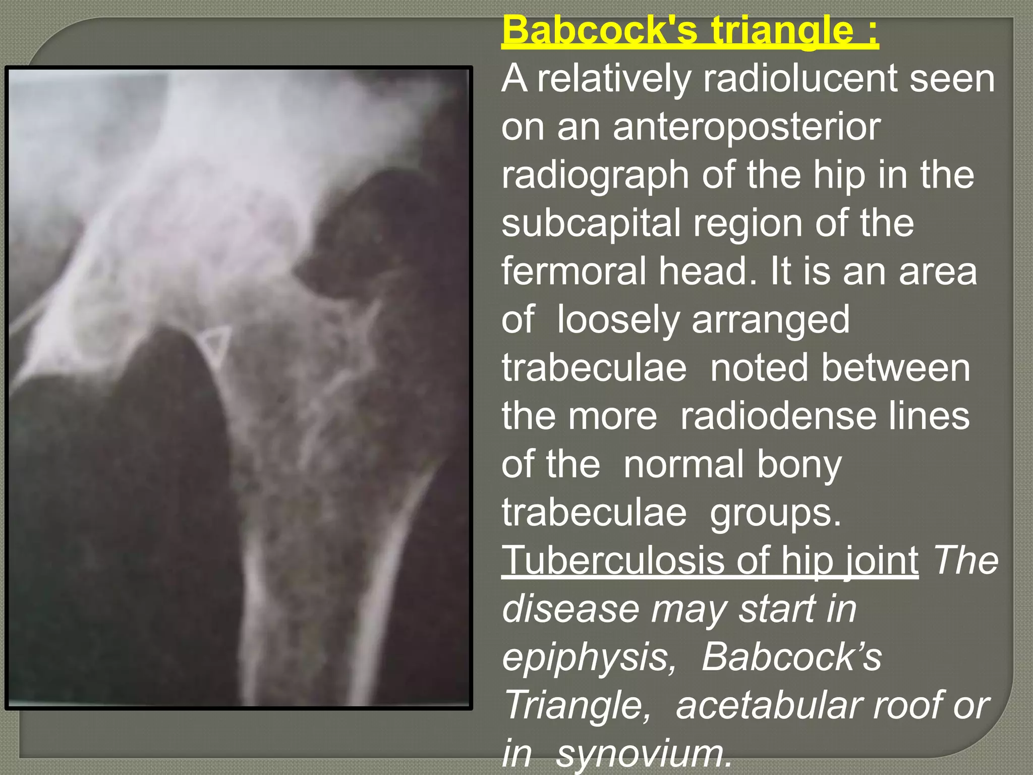 Tb hip knee shoulder dactylitis | PPTX
