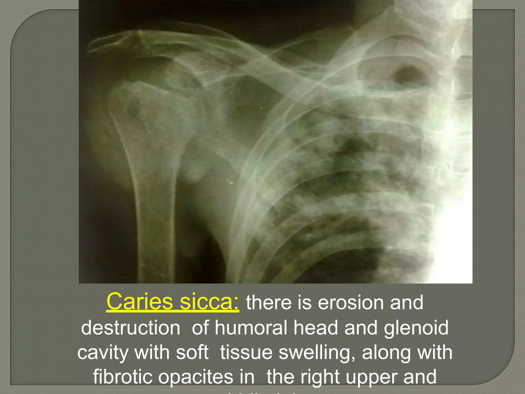 Tb hip knee shoulder dactylitis | PPTX